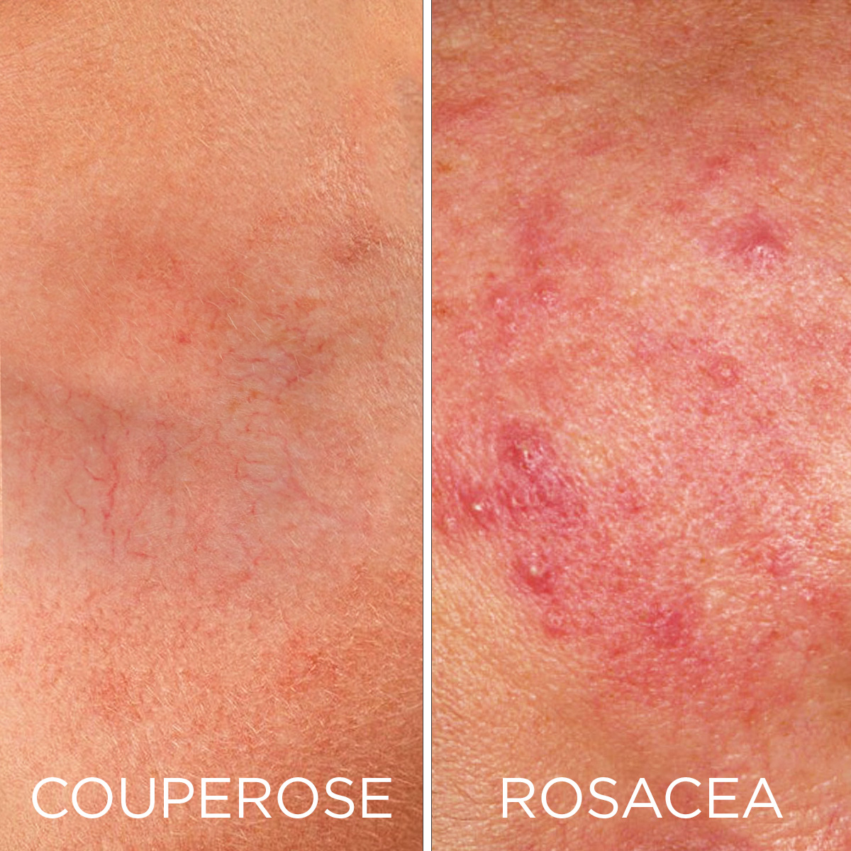 Rötungen, Couperose und Rosacea | La mer
